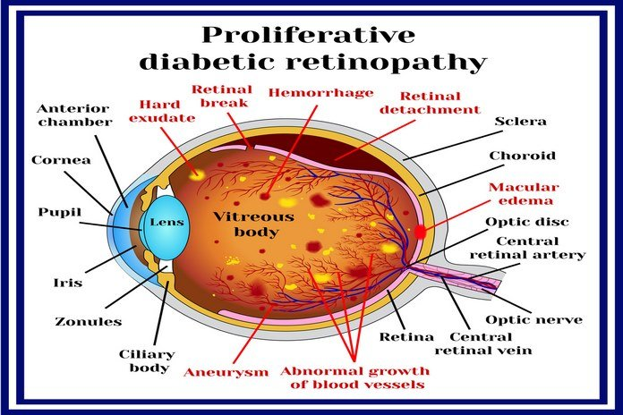 Symptoms, Causes, Types, Risk Factors, Diagnosis, Stages, Treatment ...
